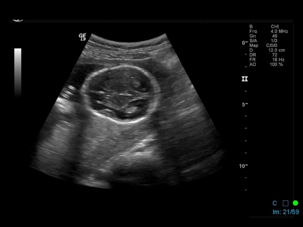 Fetal Presentation | BCPoCUS
