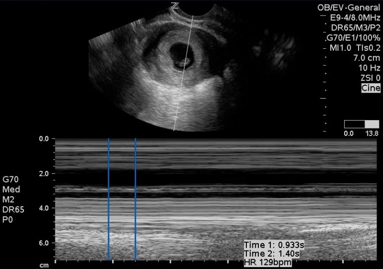 Fetal Heart | BCPoCUS